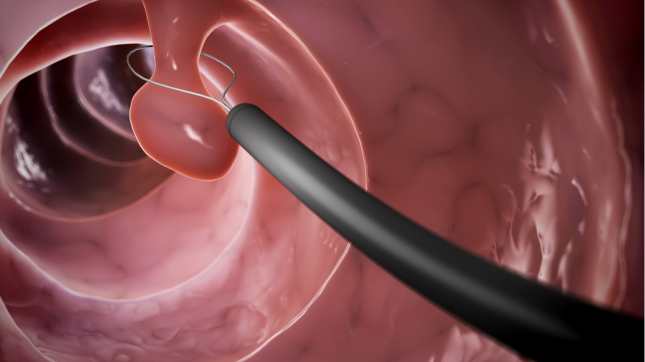 Colonoscopía: El examen para detectar el cáncer colorrectal