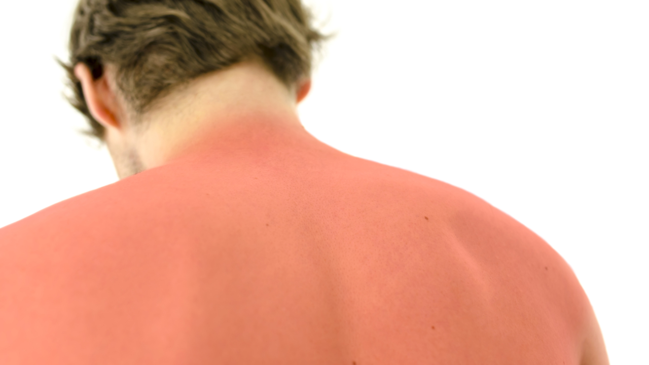 Cuatro efectos de la sobreexposición solar en la piel