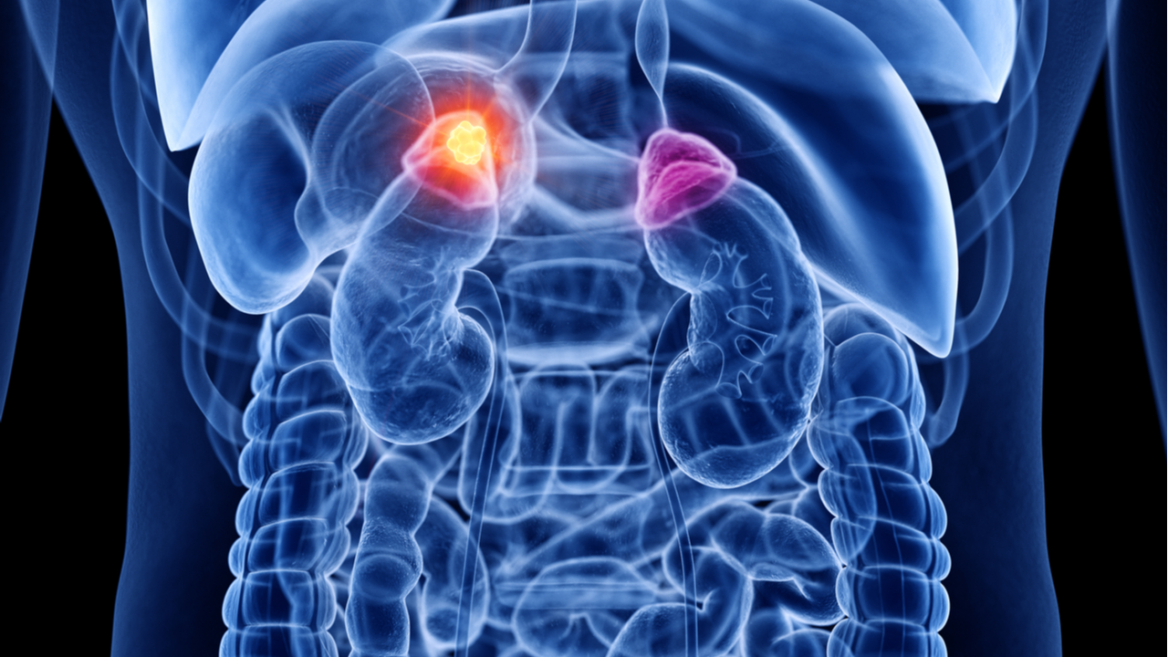 Metástasis: ¿Cómo se expande el cáncer?