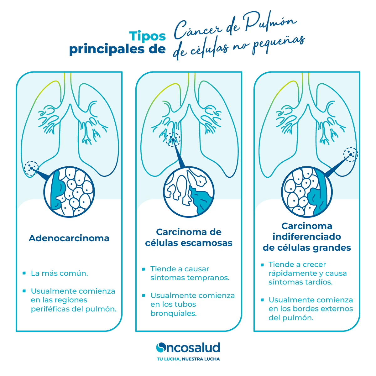 ¿El cáncer de pulmón es curable? Conoce la esperanza de vida