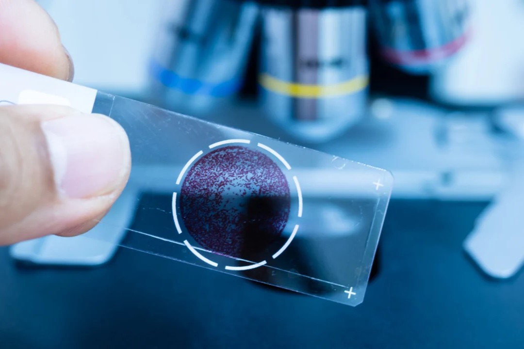 Prueba de VPH: ¿Cómo detectar el Virus del Papiloma Humano?