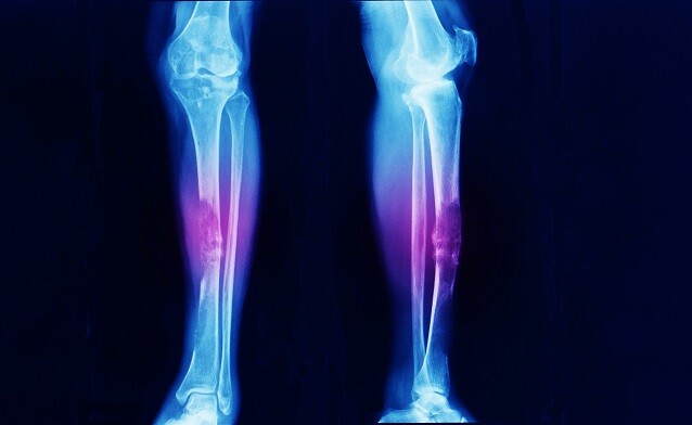 Sarcoma en el Brazo: Causas, Síntomas y Tratamiento