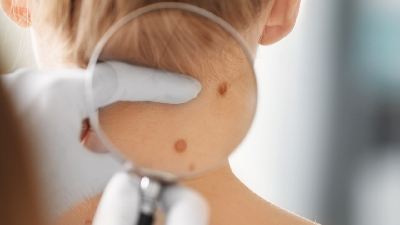 ¿Se puede eliminar lunares de forma natural? ¿Cuánto tarda?