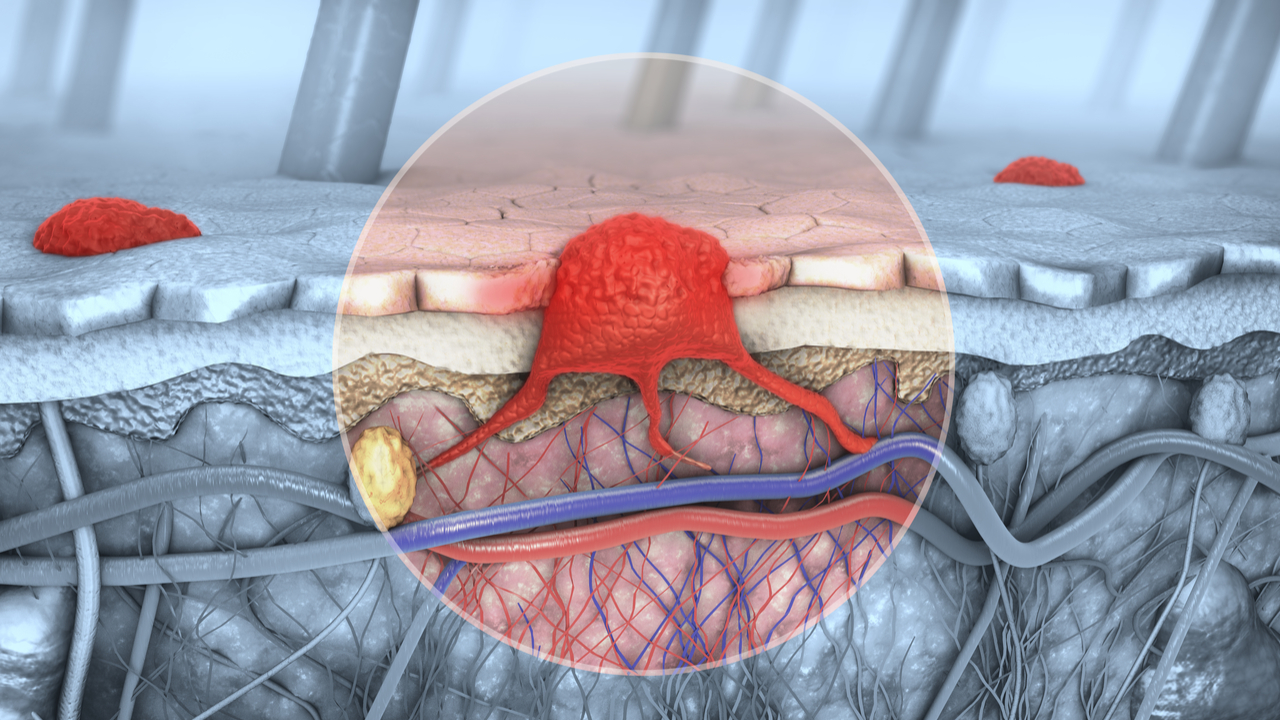 ¿Cuáles son los síntomas del cáncer linfático?