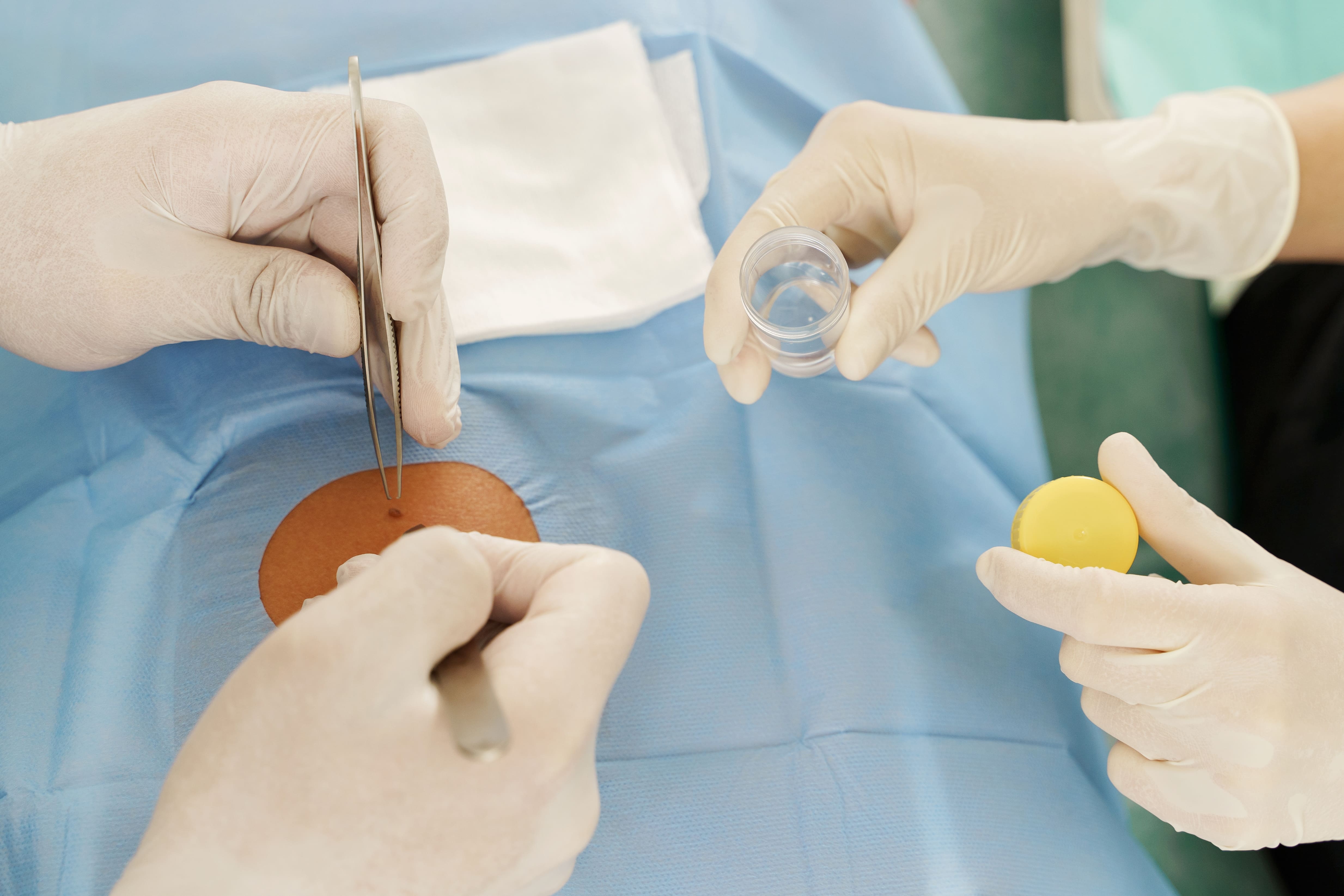 Examen de prevención de Cáncer de Piel